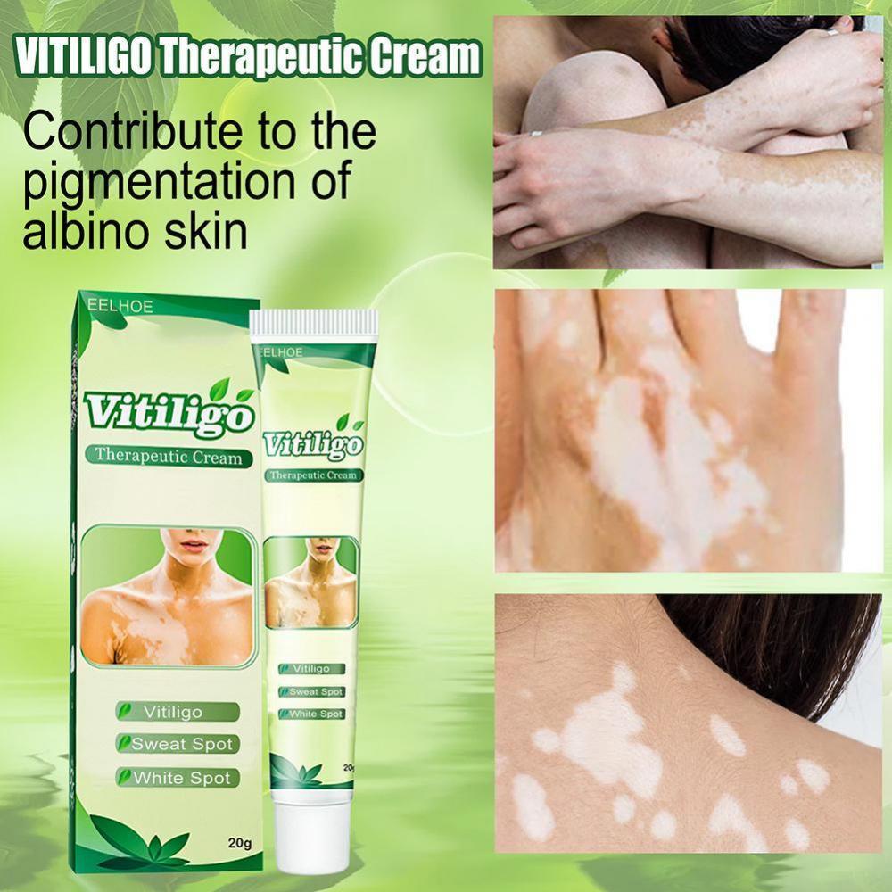 Sumifun 20g Vitiligo Crema Tratamiento Ungüento Regula Y Mejora Las ...